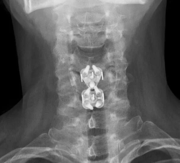 Anterior Cervical Fusion — Matthew Mian, MD