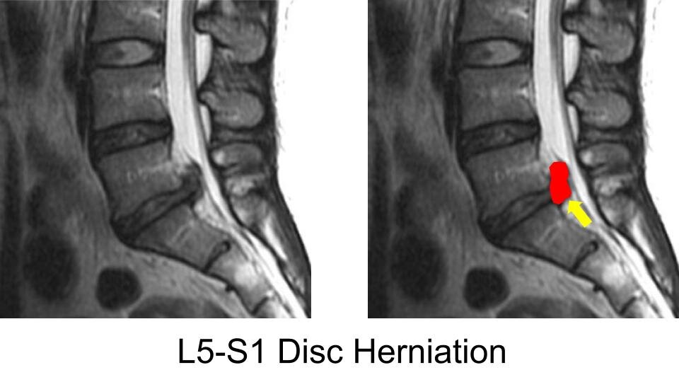 Lumbar Radiculopathy — Matthew Mian, MD