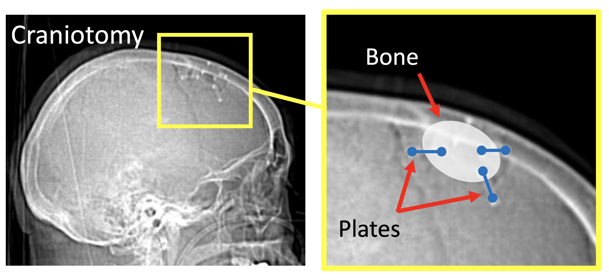 Craniotomy Vs Craniectomy: Différence Entre Craniotomie Et Ctomie – WIQP