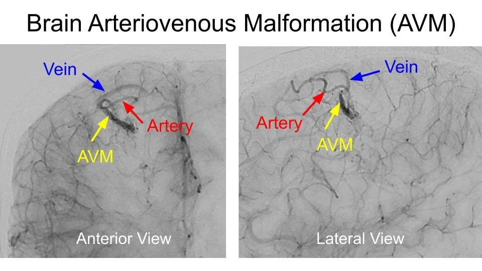 Arteriovenous Malformation — Matthew Mian, MD