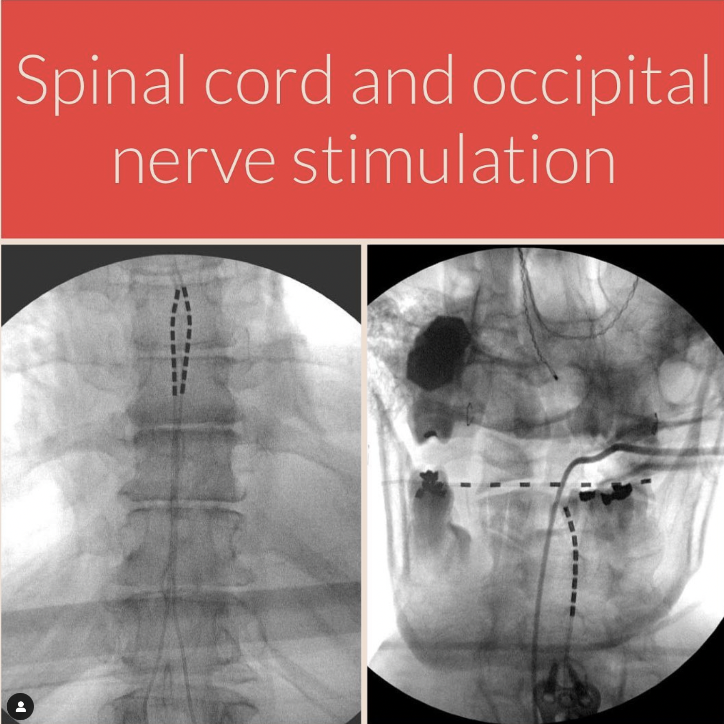 Spinal Cord Stimulation — Matthew Mian, MD