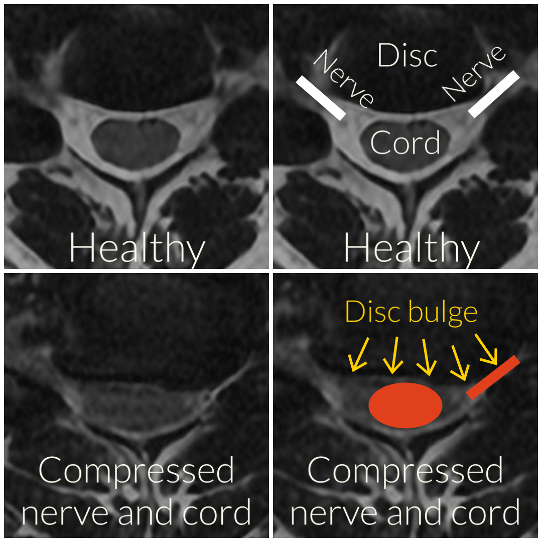 Cervical Radiculopathy — Matthew Mian, MD