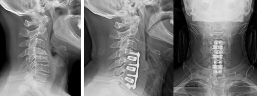 Ant. Cervical Discectomy & Fusion — Matthew Mian, MD