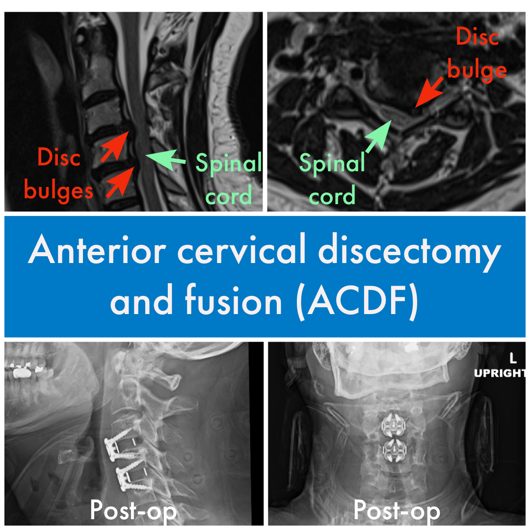 Anterior Cervical Fusion Matthew Mian MD