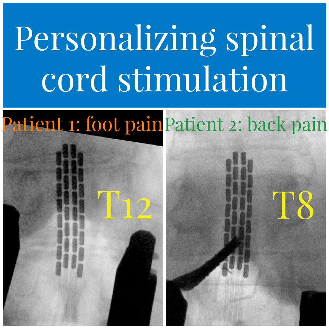 Spinal Cord Stimulation — Matthew Mian, MD