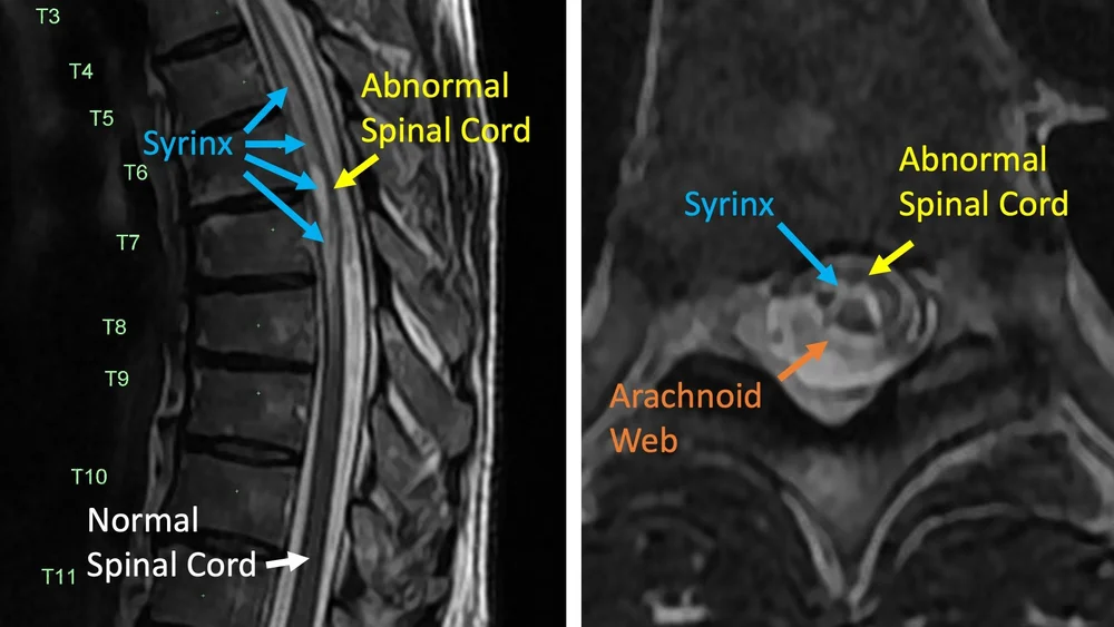 Arachnoid Web — Matthew Mian, MD