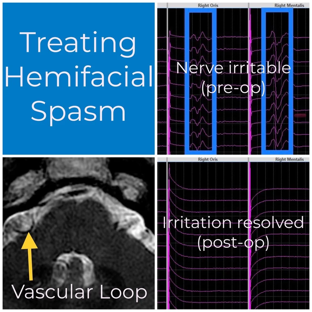 Hemifacial Spasm — Matthew Mian, MD