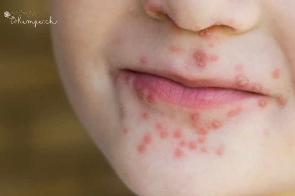 Die Hand-Mund-Fuss-Krankheit bei Kindern — Naturheilkunde für Kinder