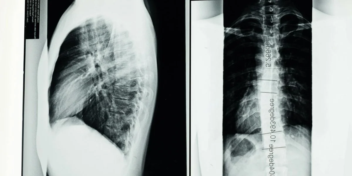 Structural vs Functional Scoliosis: Key Differences Explained