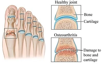 Synthetic Cartilage Joint Implant For Big Toe Joints- Brooklyn Foot ...