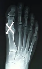 Synthetic Cartilage Joint Implant For Big Toe Joints- Brooklyn Foot ...