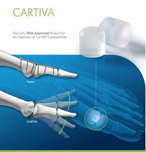 Synthetic Cartilage Joint Implant For Big Toe Joints- Brooklyn Foot ...