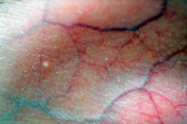 Vascular Lesions / Thread Vein Treatments • Panakeia (UK) — Panakeia ...