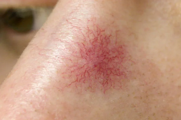 Vascular Lesions / Thread Vein Treatments • Panakeia (UK) — Panakeia ...