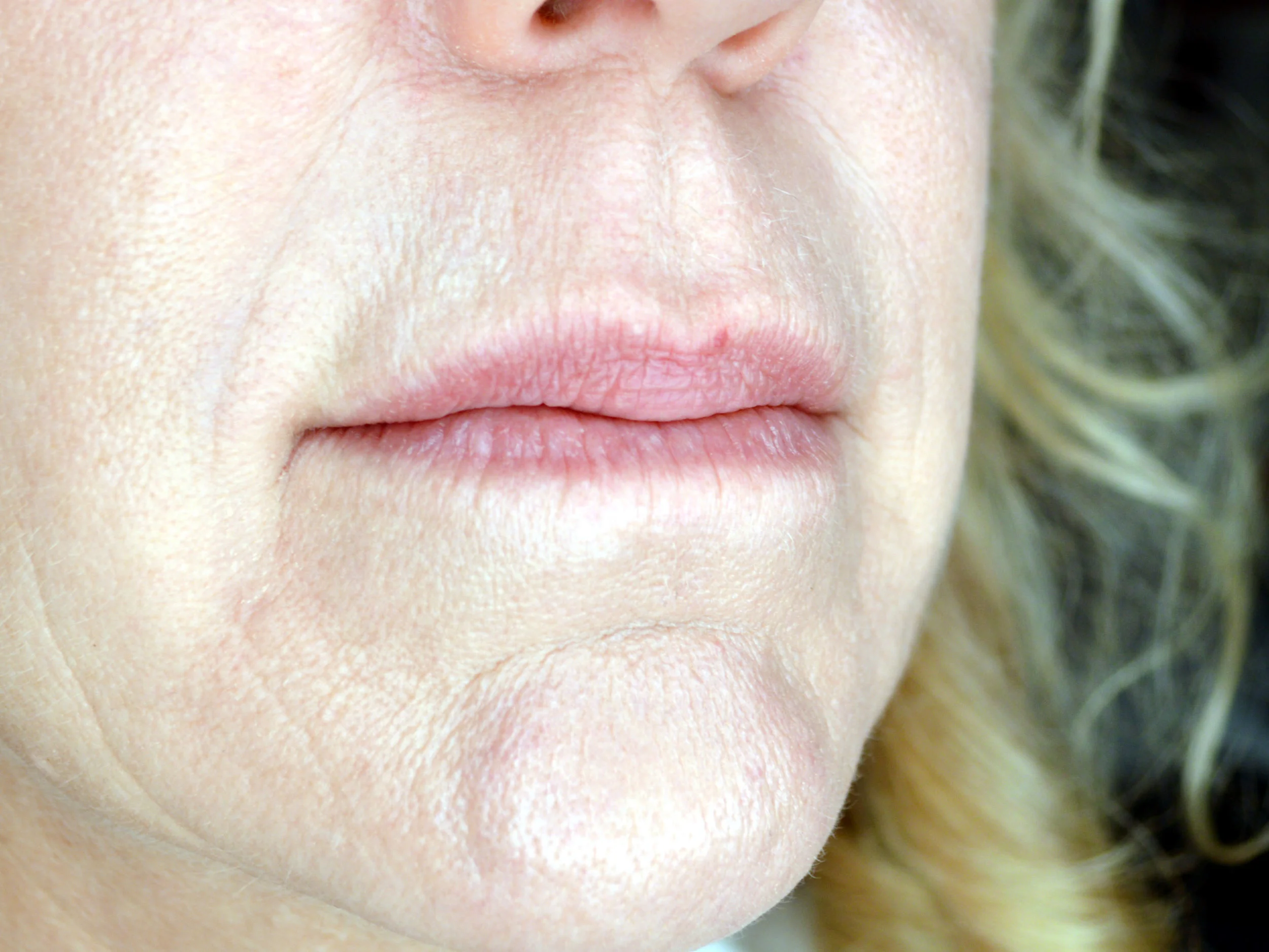 Face--Nasolabial Folds — CPW Vein and Aesthetic Center