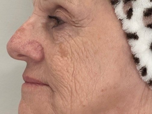 Gallery Before After Skin Neck Laxity — CPW Vein and Aesthetic Center