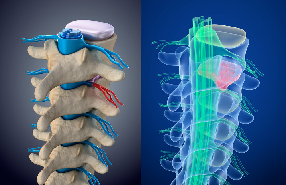 Herniated Disc Treatment – What to Follow