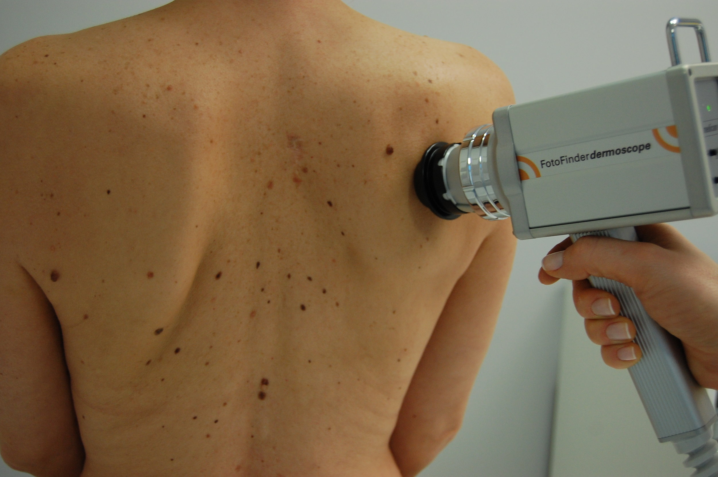 Dermatoscopia Digital — Louise Lovatto