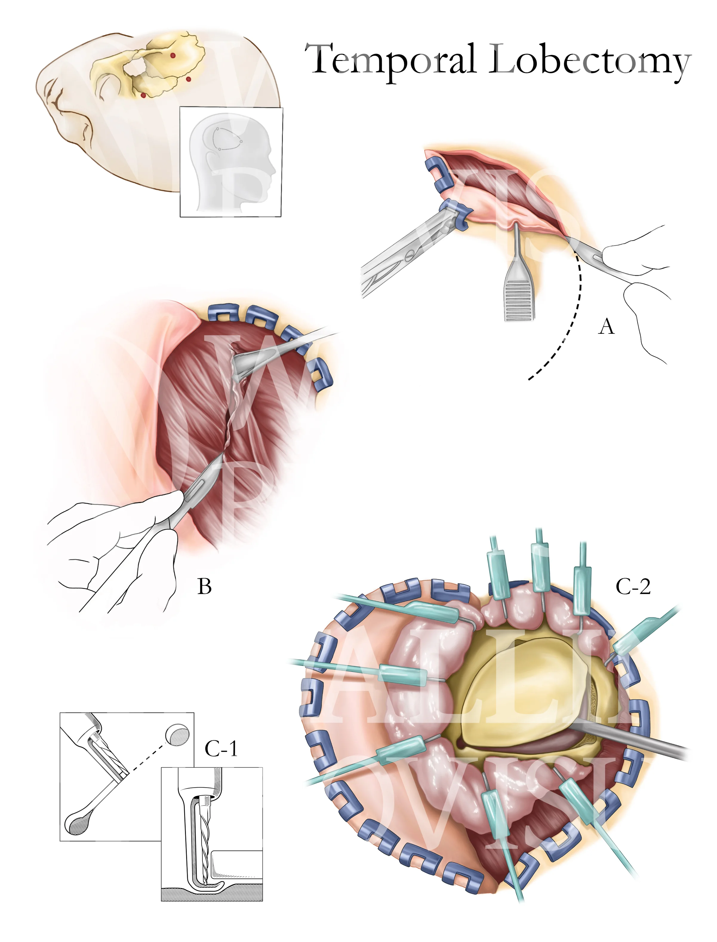 Temporal Lobectomy Wallin Biovisuals Temporal Lobectomy Wallin Biovisuals