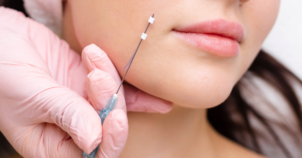 Mint PDO Threads Before and After — SkinPlus MedSpa