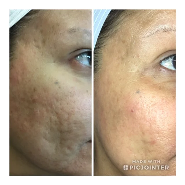 Vivace RF Microneedling — SkinPlus MedSpa