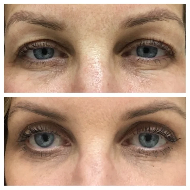 SmartSkin C02 Laser - Prescott, AZ - SkinPlus MedSpa