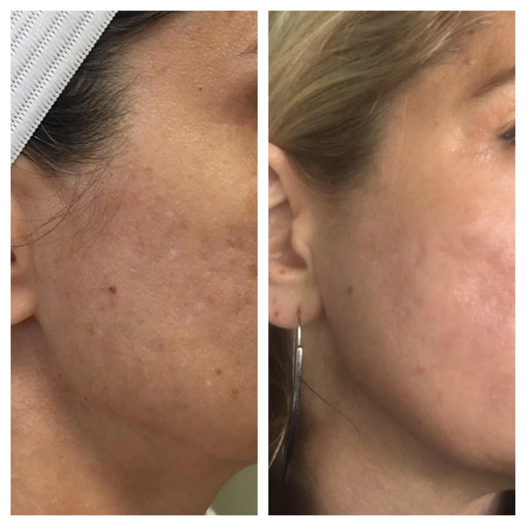 SmartSkin C02 Laser - Prescott, AZ - SkinPlus MedSpa