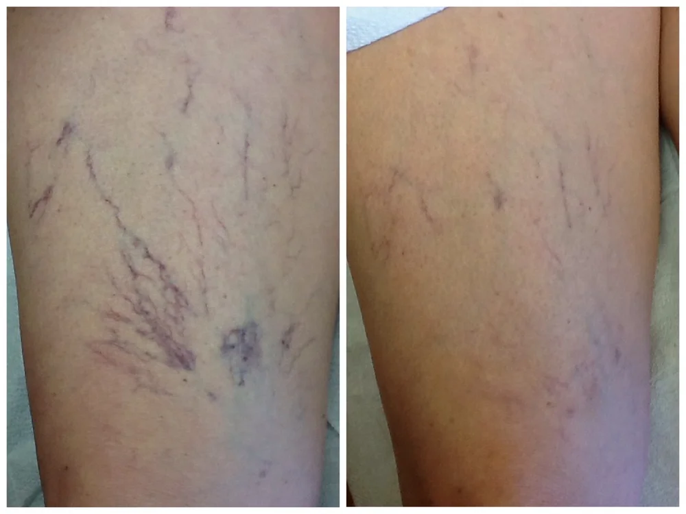 Laser and IPL Photofacial Treatments - Prescott, AZ - SkinPlus MedSpa