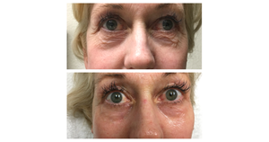 What is CooLifting Facial Treatment? — SkinPlus MedSpa