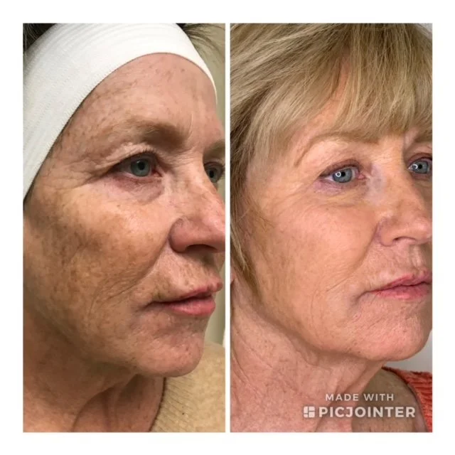 SmartSkin C02 Laser - Prescott, AZ - SkinPlus MedSpa