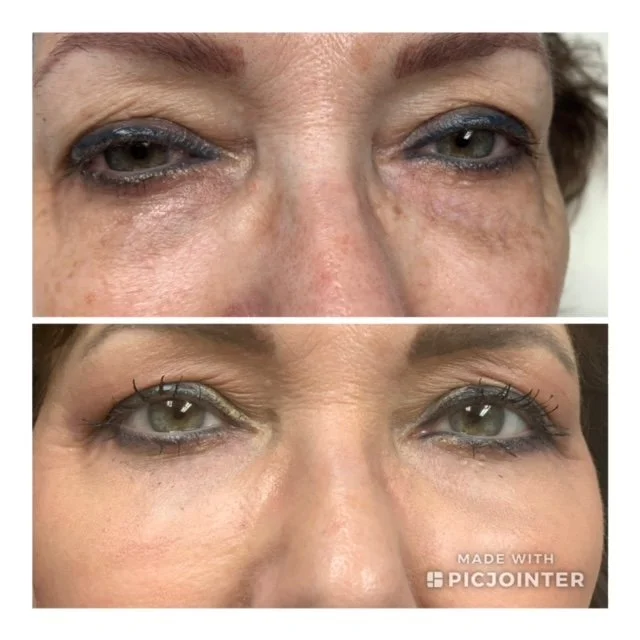 SmartSkin C02 Laser - Prescott, AZ - SkinPlus MedSpa