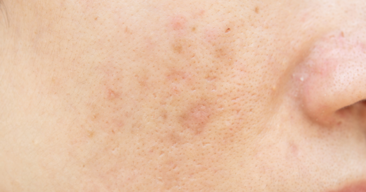 Laser Treatment for Dark Spots on Face Price — SkinPlus MedSpa