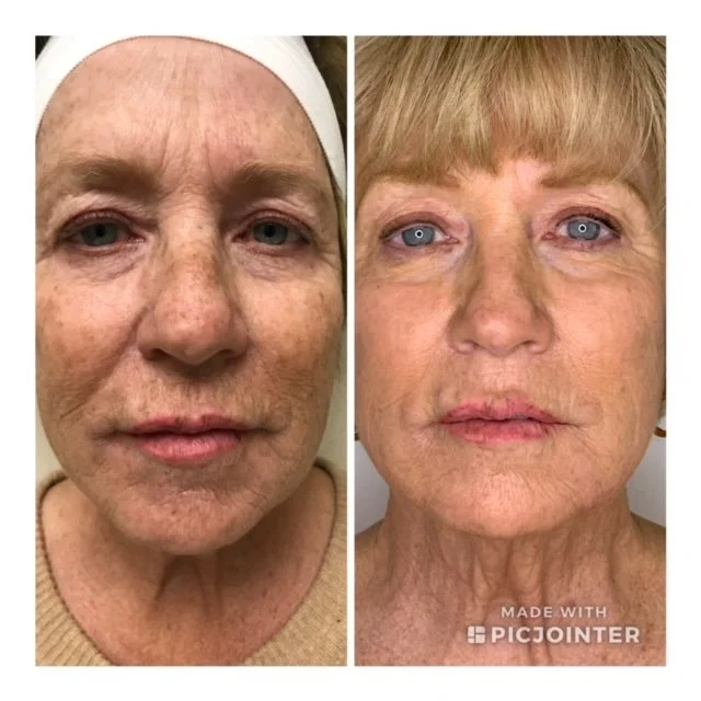 SmartSkin C02 Laser - Prescott, AZ - SkinPlus MedSpa