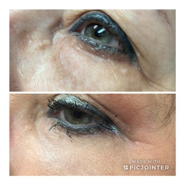 SmartSkin C02 Laser - Prescott, AZ - SkinPlus MedSpa