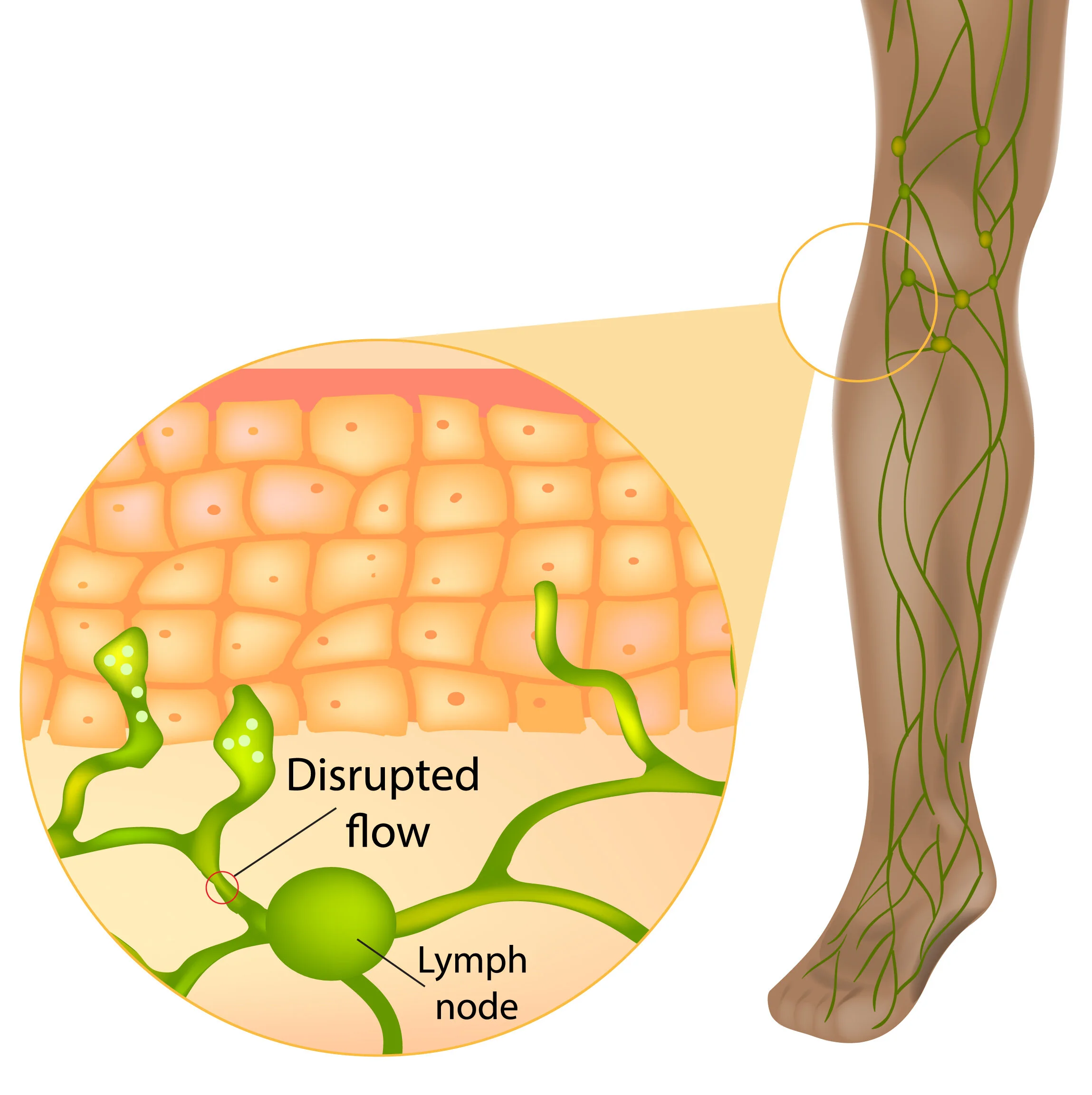 Lymphedema Diagram