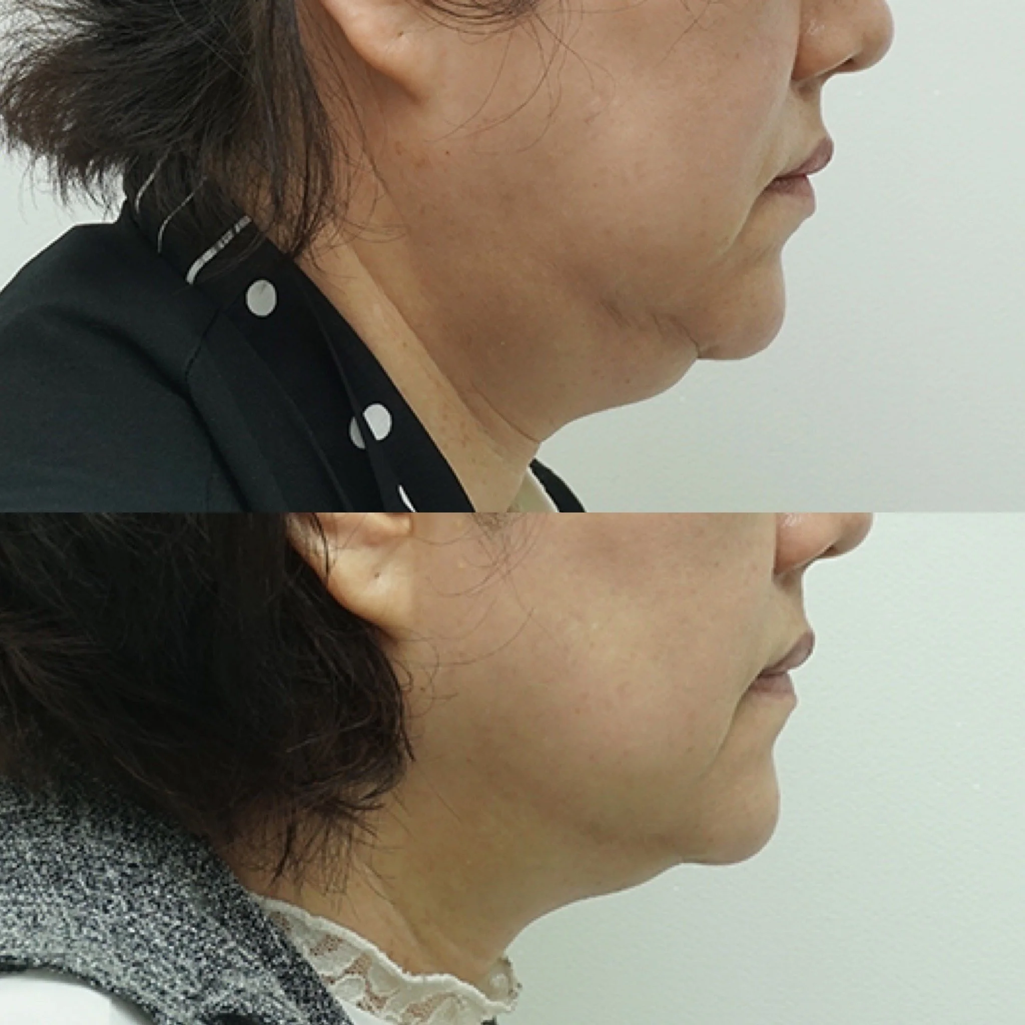 Clatuu Alpha Fat Freezing — Bare Laser and Skin Clinic