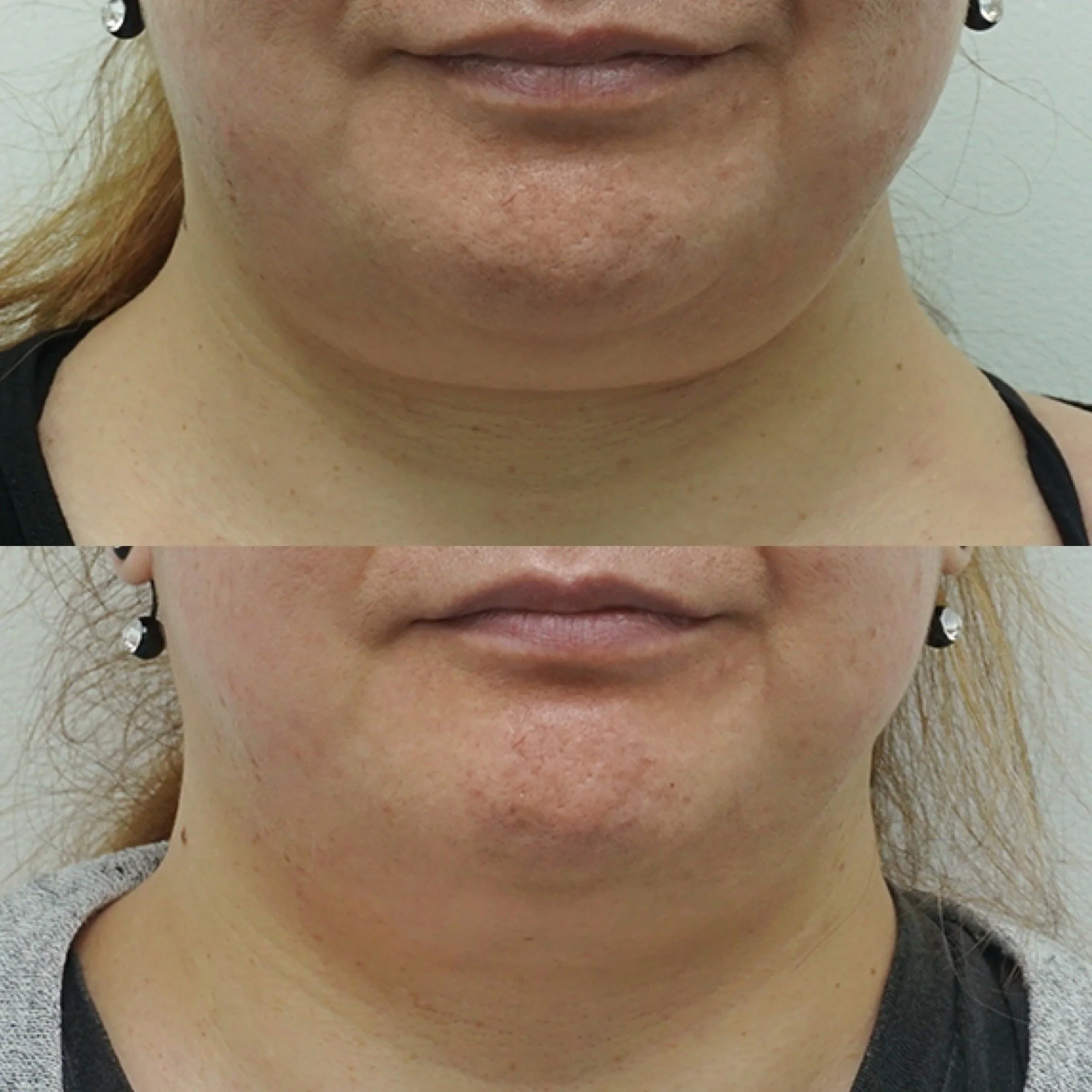 Clatuu Alpha Fat Freezing — Bare Laser and Skin Clinic