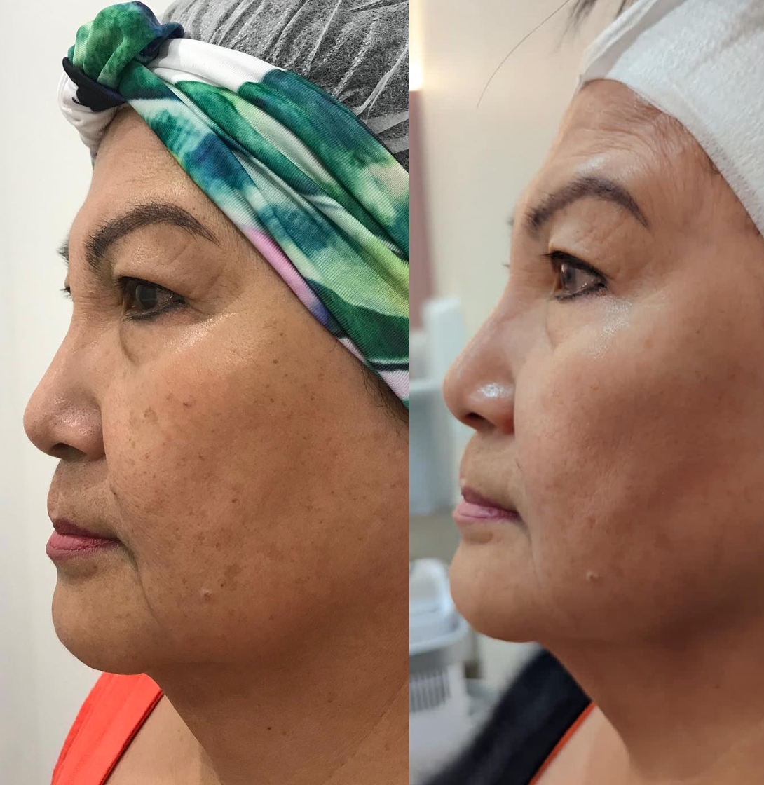 Thermage FLX Face — Bare Laser and Skin Clinic