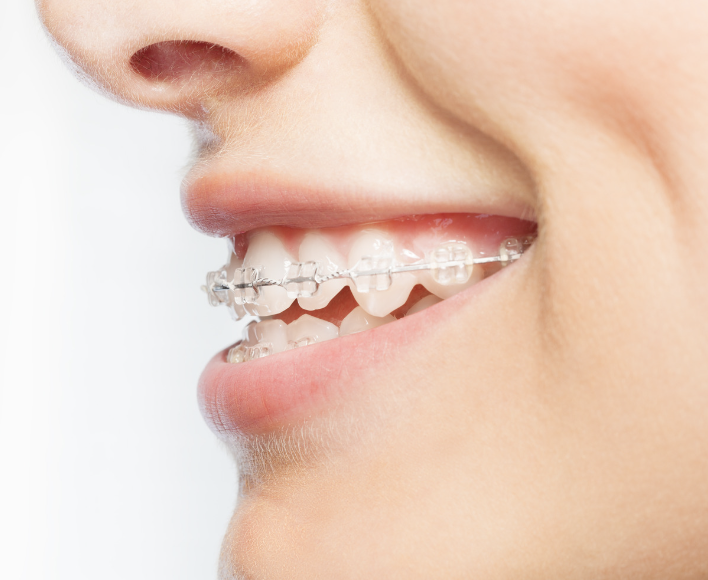 Clear Ceramic Braces for Teens at Crossley Orthodontics — Crossley Ortho