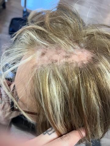 Hair Thinning On One Side Of Head | Causes & Treatments