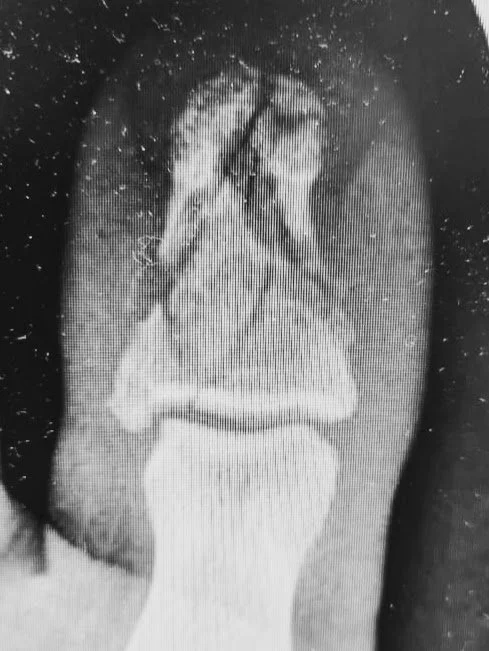 Traditional Chinese Medicine Case Report: Broken Big Toe — Alina Rehkopf