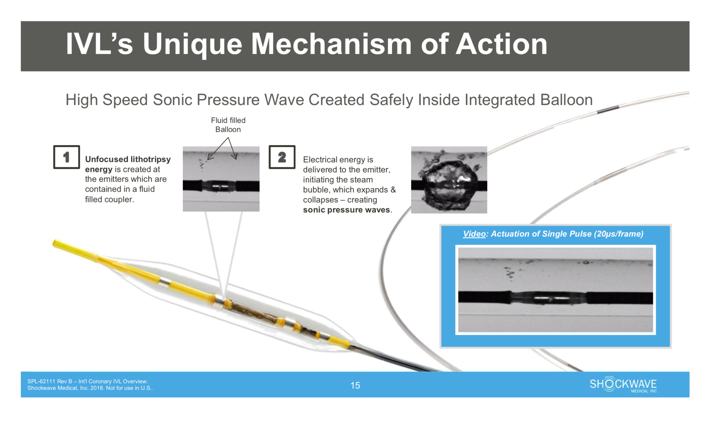 SHOCKWAVE IVL (IntraVascular Lithotripsy) — RODNIE ORO SHOCKWAVE IVL (IntraVascular Lithotripsy) — RODNIE ORO
