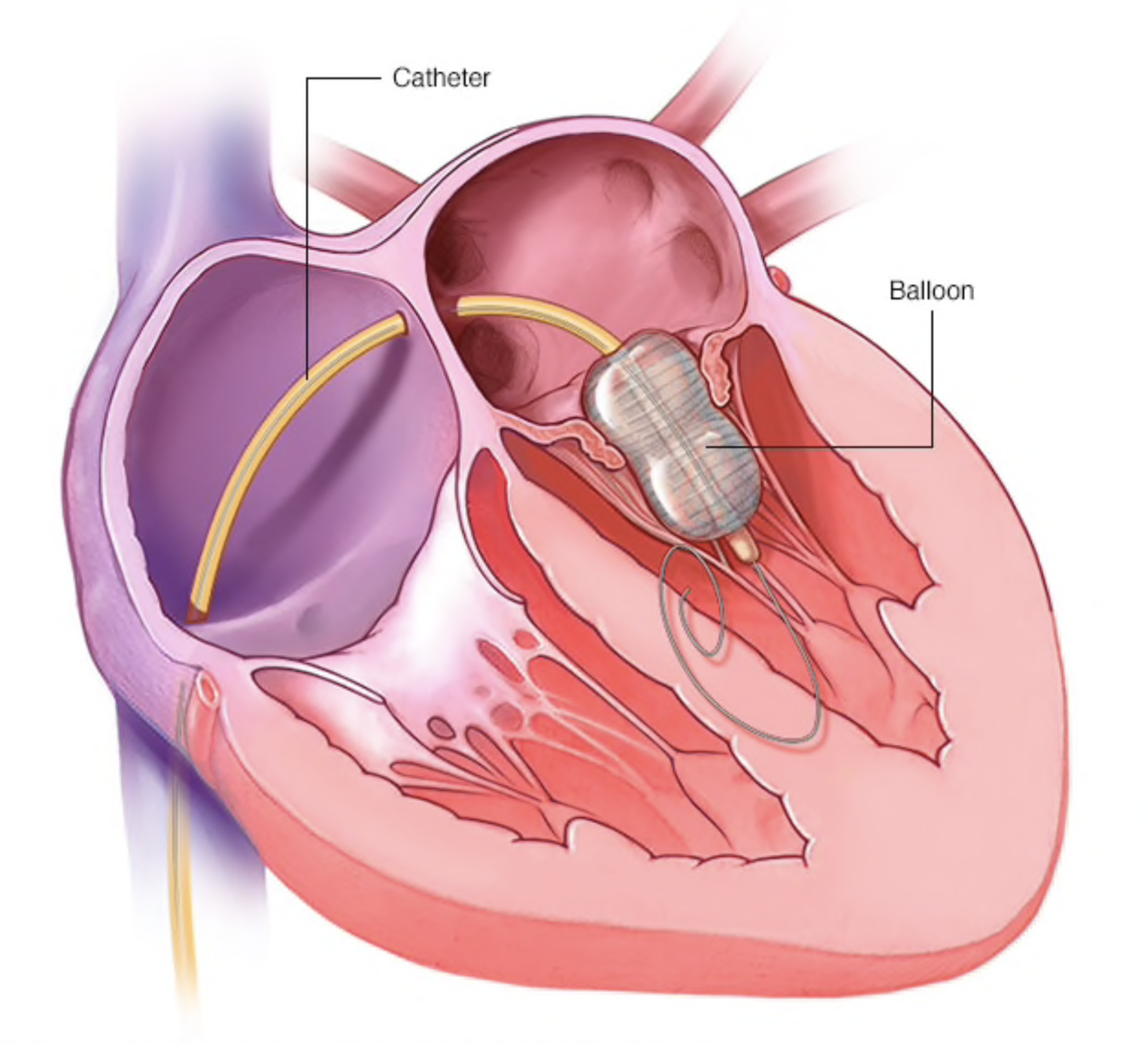 Balloon Mitral Valvuloplasty RODNIE ORO Balloon Mitral Valvuloplasty RODNIE ORO