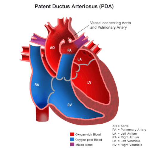 PDA (Patent Ductus Arteriosus) Closure — Golden Shutter Films