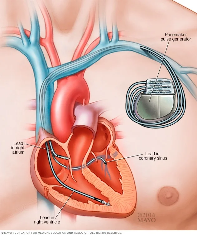 Permanent Pacemaker PPM ICD CRT RODNIE ORO Permanent Pacemaker PPM ICD CRT RODNIE ORO