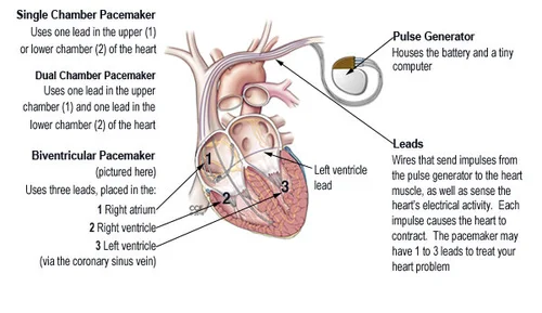 Permanent Pacemaker (PPM, ICD, CRT) — Golden Shutter Films