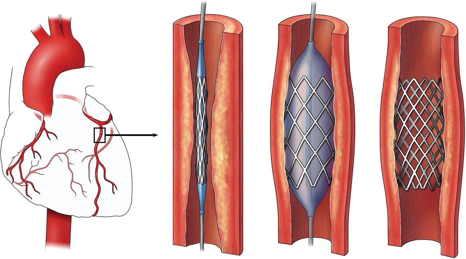 Percutaneous Coronary Intervention (PCI) — Golden Shutter Films