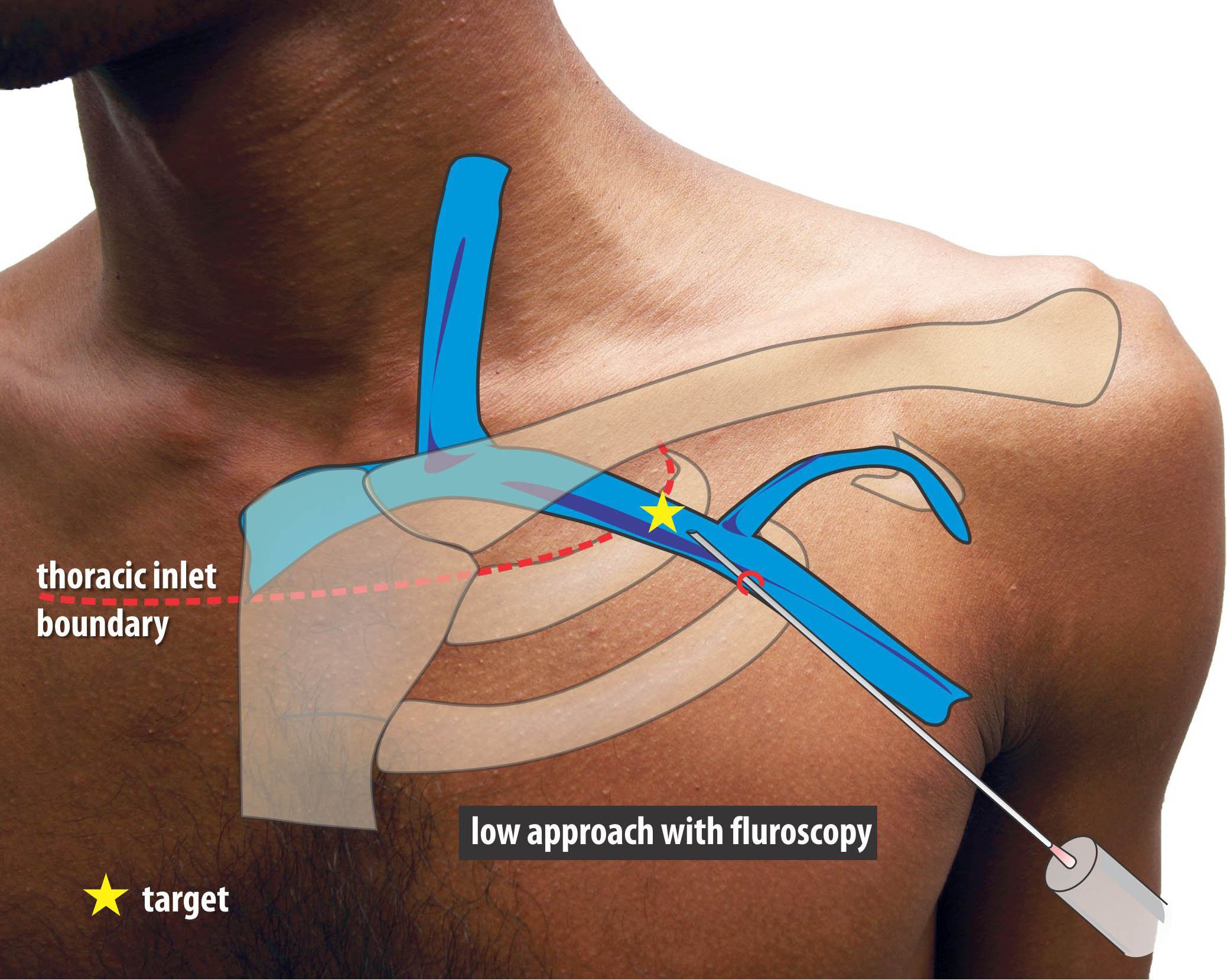 Permanent Pacemaker PPM ICD CRT Golden Shutter Films Permanent Pacemaker PPM ICD CRT Golden Shutter Films