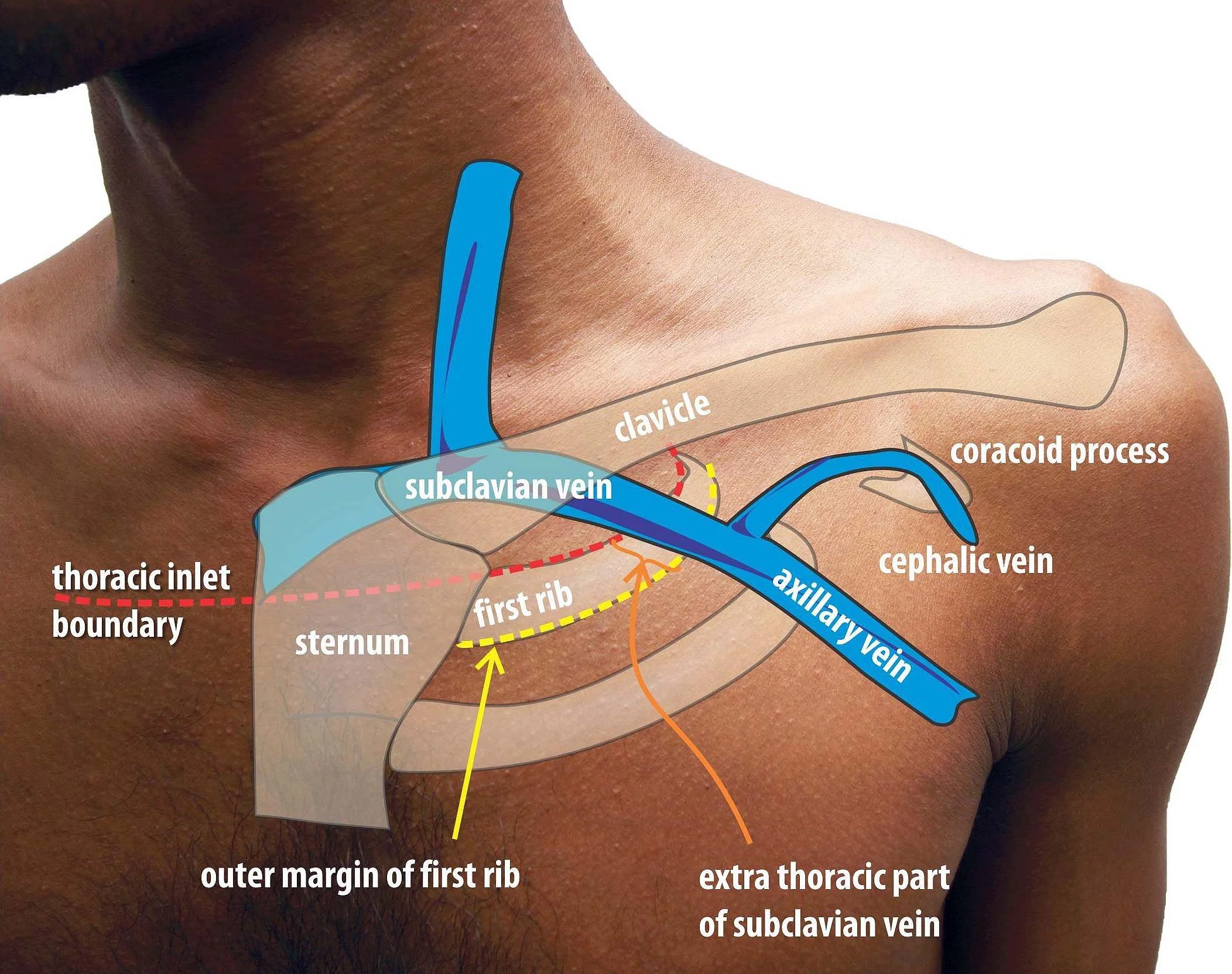 Permanent Pacemaker PPM ICD CRT Golden Shutter Films Permanent Pacemaker PPM ICD CRT Golden Shutter Films