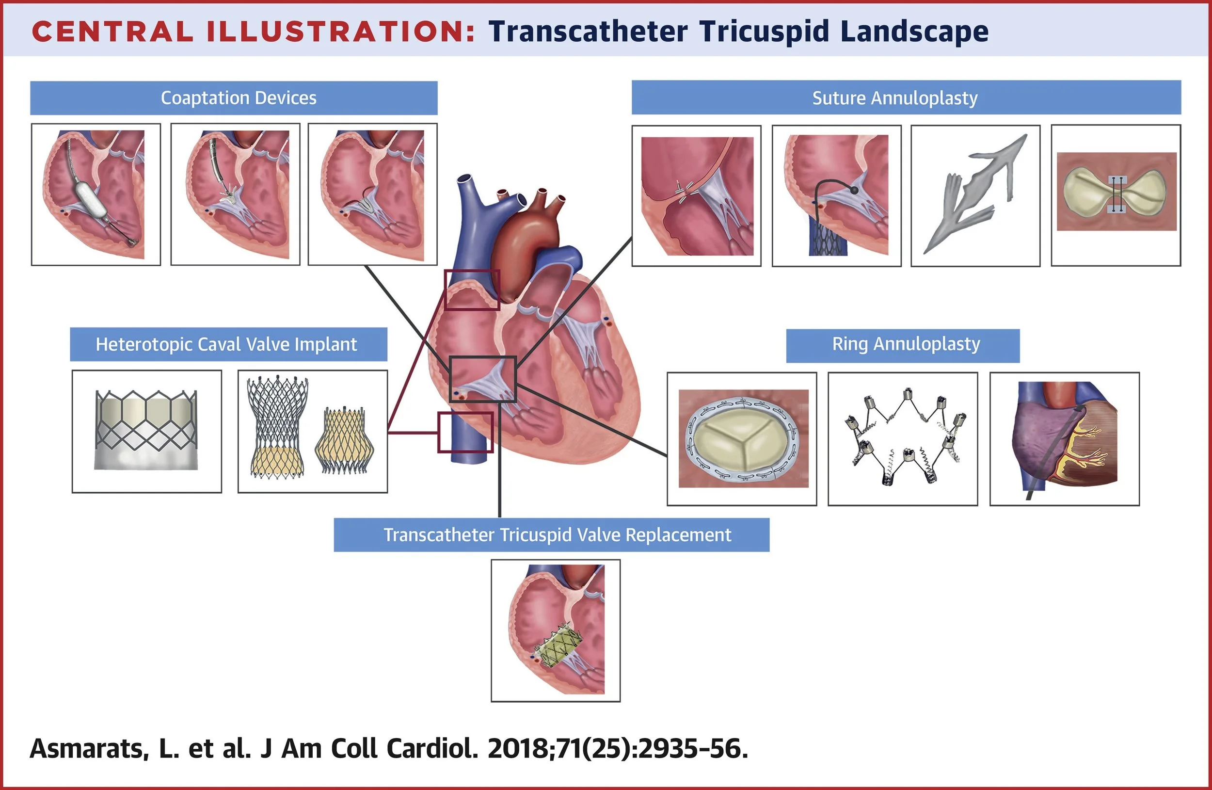 Tricuspid Clip (TriClip), TEER (Transcatheter Edge-to-Edge Repair of the Tricuspid leaflet ...